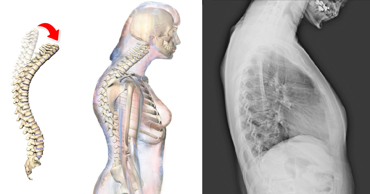 Jakie materace wybierać przy kifozie? - Sentomy